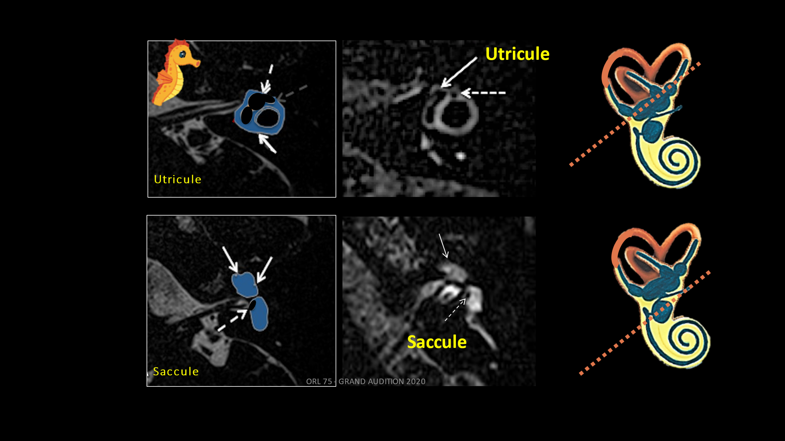 VESTIBULOPATHIES BILATERALES ET APPARENTEES